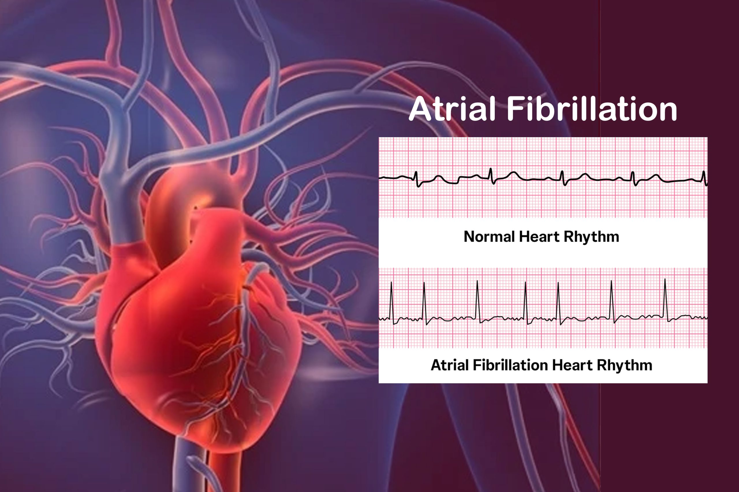 Conquer Atrial Fibrillation with Kribado: Your AFIB Risk Stratification ...