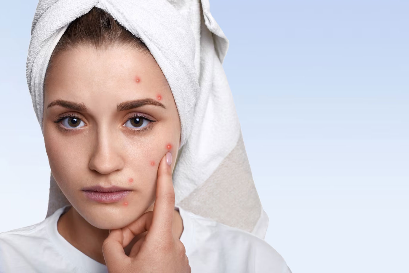 Optimize Acne Treatment with IAA Acne Score - Indigital Technologies LLP